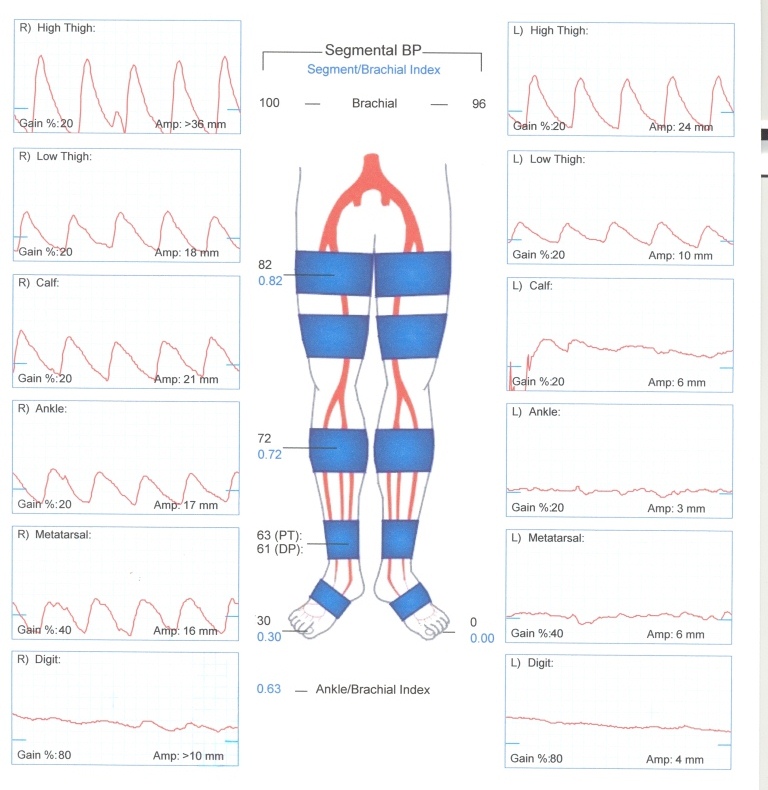 Pulse Volume Recording (PVR)