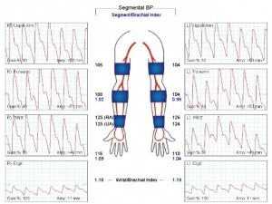 Upper extremity Pulse volume recording - Angiologist