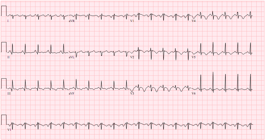 Pulmonary embolism