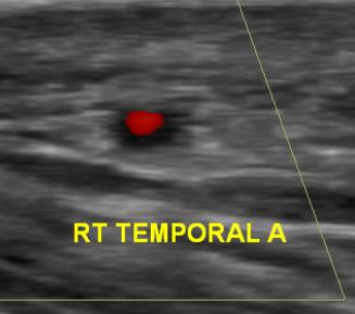 Giant cell Arteritis