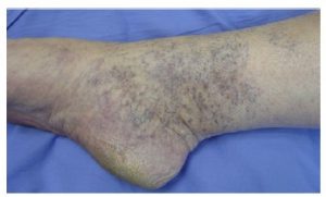 Purple Feet - What are the causes? What needs to be done?