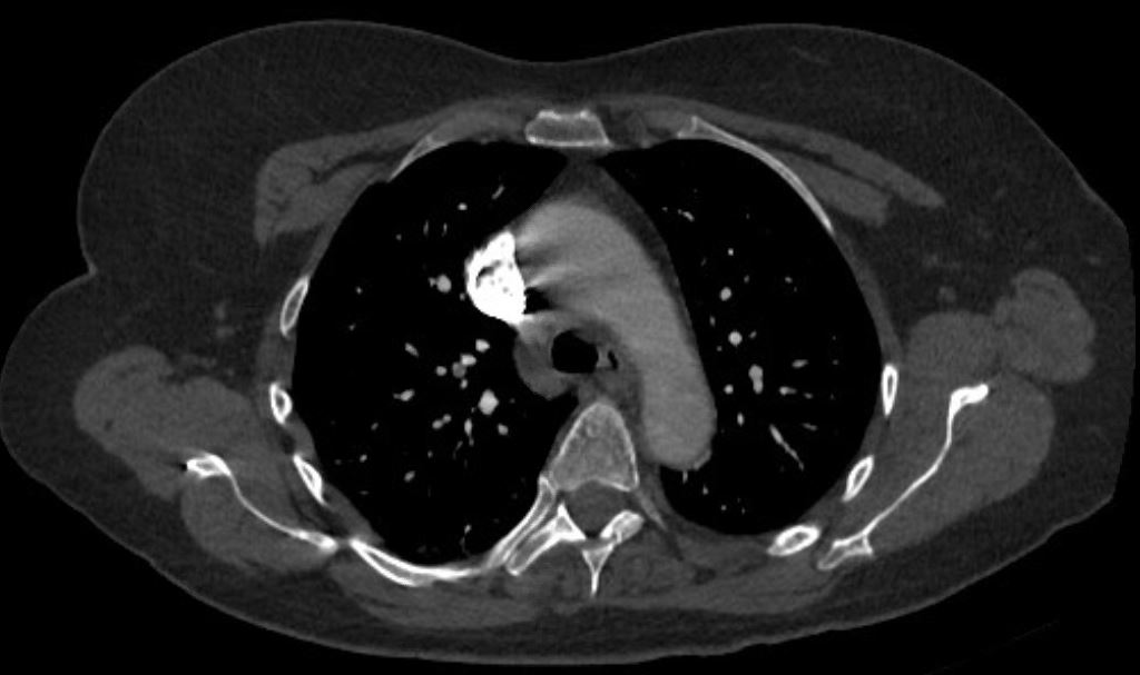 Subsegmental pulmonary embolism: Should you treat? For how long?