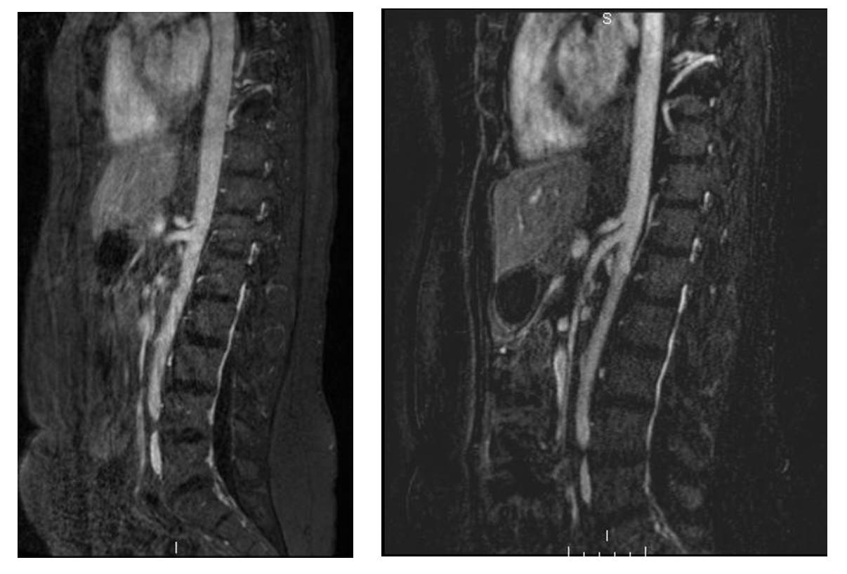 Median Arcuate Ligament Syndrome: Diagnosis and Treatment