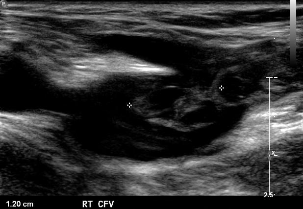 EVLA - Endovenous Laser Ablation - Angiologist